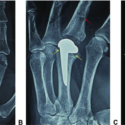 Postoperative Plain Radiographs Following The Second Stage Revision