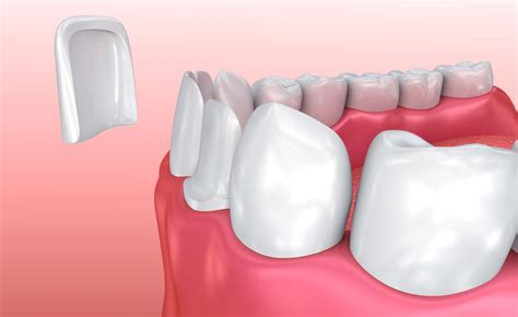 Historia De Los Implantes Dentales Estudi Dental Barcelona