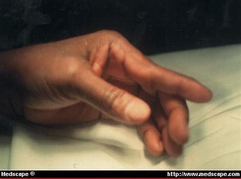 Climbing Resulting In Hyperextended PIP Joint R Climbing