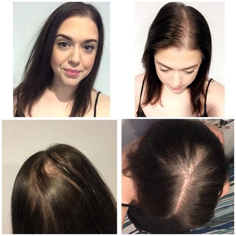 How To Hide Thinning Hair At The Front Extensions For Thin Hair