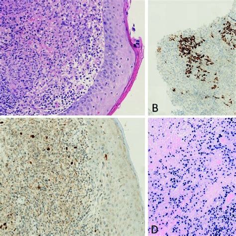 Multiple Purplish Ulcerated Nodular Lesions On The Left Thigh