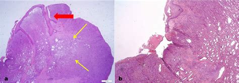 Hpe Sections Revealed A A Polypoidal Lesion Composed Of Aggregates Of