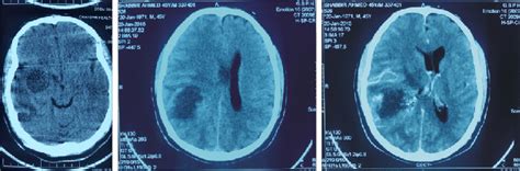 Non Contrast Computed Tomography NCCT Scan Of The Brain In August