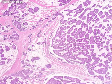Mucinous Carcinoma Of Breast Prognosis