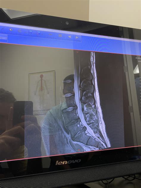 Update On Herniated Disc Leg Sciatica 3 Months In Surgery Or