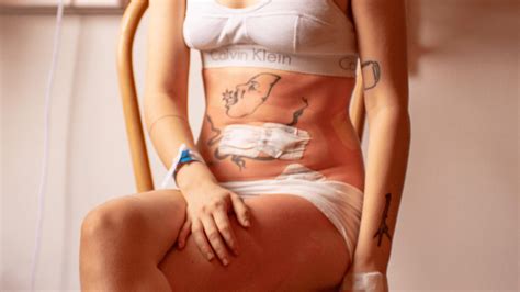 Treatment Option For Endometriosis Excision Vs Ablation Somedays