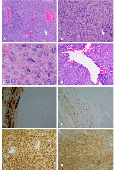 Morphology And Ihc Of The Thyroid Lesion A B C D E F G H A Loss Of Download Scientific