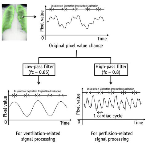 Examples Of Diaphragmatic Motion In Tidal Breathing A D A 60 Year Old