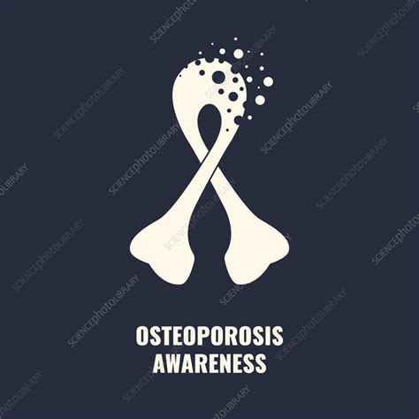 Osteoporosis Conceptual Illustration Stock Image F0386222