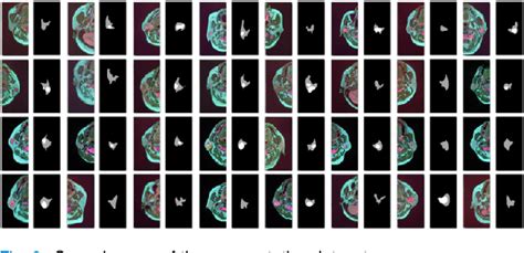 Figure 1 From Segmentation Of Parotid Gland Tumors Using Multimodal MRI