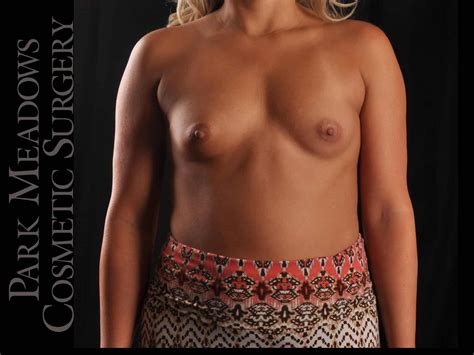Silicone Breast Augmentation Park Meadows Cosmetic Surgery