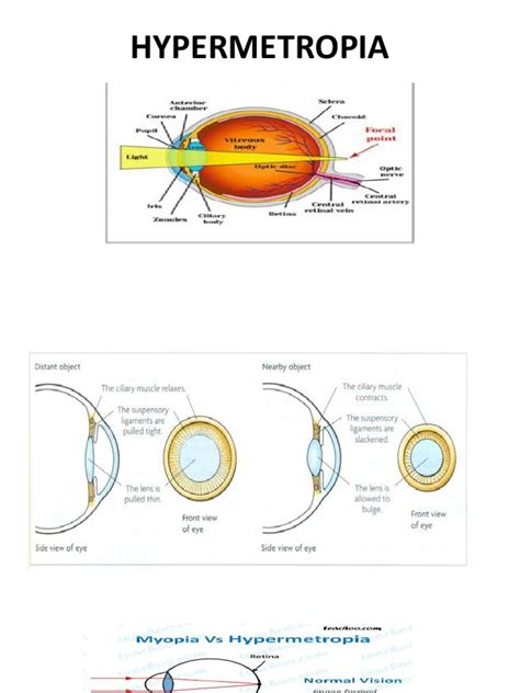 Hypermetropia And Myopia Pdf Pdf Human Eye Diseases And Disorders
