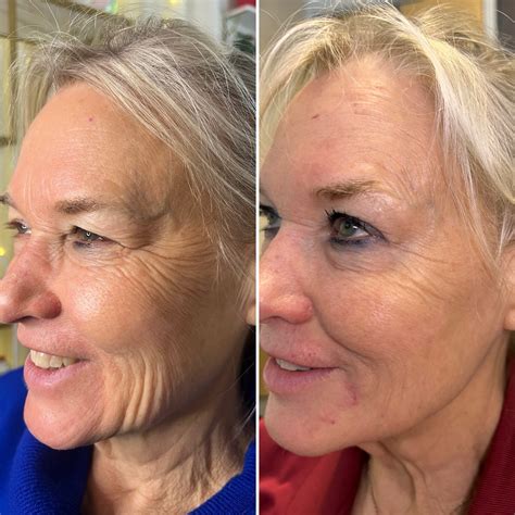 sculptra before and after 2 vials 7 months apart this client has