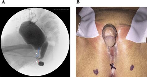 A Lateral Genitography Showing The Vaginal Depth Red Line Labelled Download Scientific