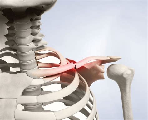 Clavicle Fracture Open Reduction And Internal Fixation Artofit