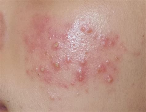 [acne] How Can I Get Rid Of These Pustules On My Cheeks R