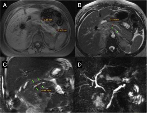 Magnetic Resonance Cholangiography A T1 Weighted Axial View Showing Download Scientific