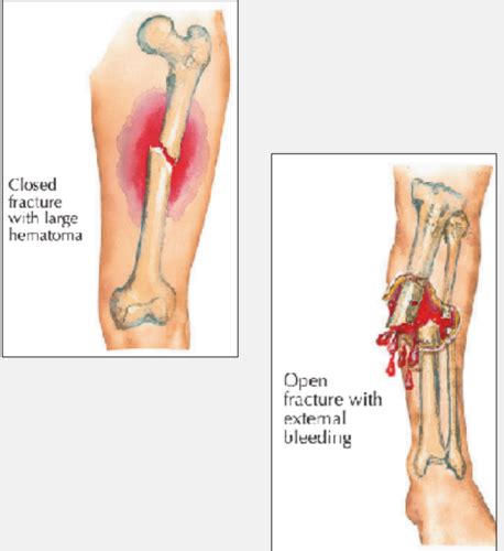 Fracture General Considerations Flashcards Quizlet