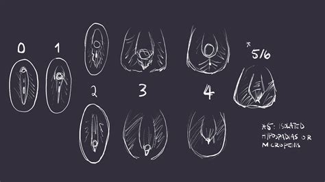 What Is Intersex Difference Of Sex Development Intersex