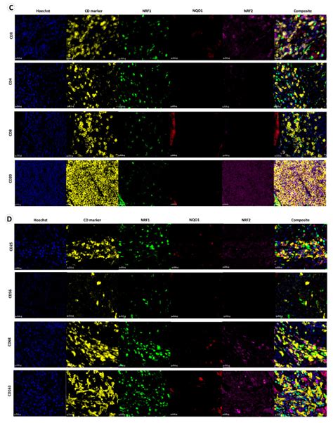 Spatial Analysis Of Nqo1 In Non Small Cell Lung Cancer Shows Its
