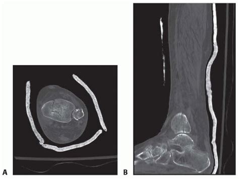 Intramedullary Nailing Of Metaphyseal Proximal And Distal Fractures Musculoskeletal Key