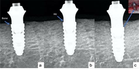 Digital Periapical Radiographs For The Control Implants A Control