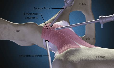 Right Hip Of A Patient In The Supine Position Showing Puncture