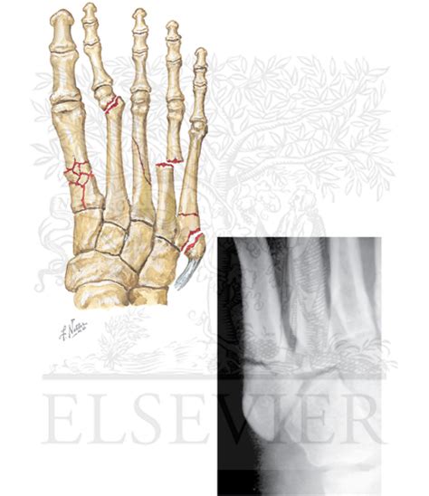 Fifth Metatarsal Fractures