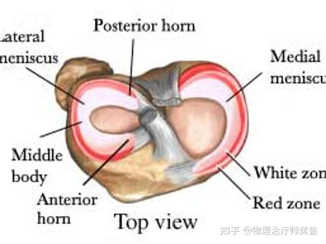 半月板的损伤分类（Ⅰ型Ⅱ型Ⅲ型）——物理治疗师之影像学系列一 知乎