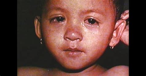Even One Vaccination Works Five Things To Know About Measles