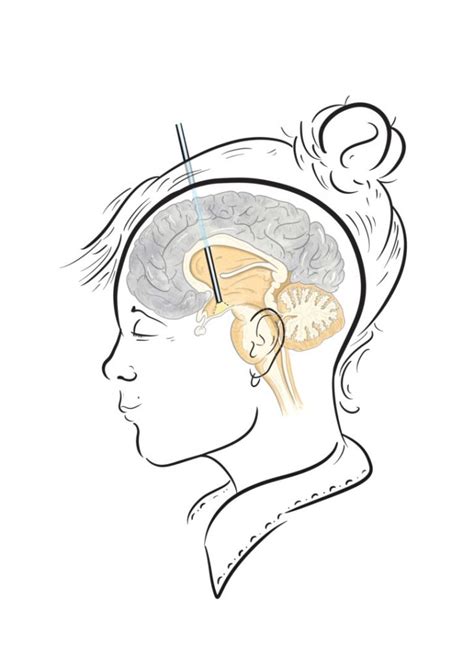 Endoscopic Third Ventriculostomy Etv Brainbook