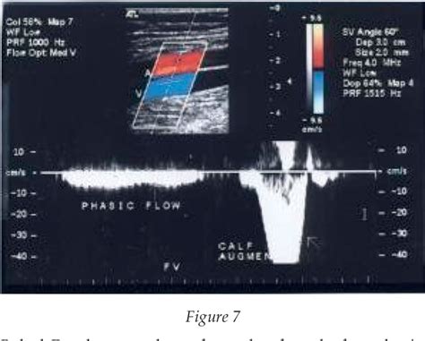 Figure 1 From Venous Waveforms Semantic Scholar