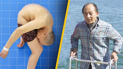 The ‘folded Man Finally Stands Up Straight After 28 Years Youtube