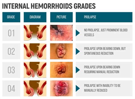 Mild Hemorrhoid Prolapsing Hemorrhoids Intechopen