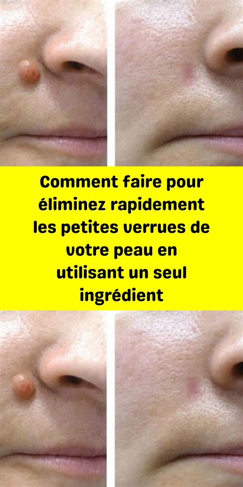 Comment faire pour éliminez rapidement les petites verrues de votre