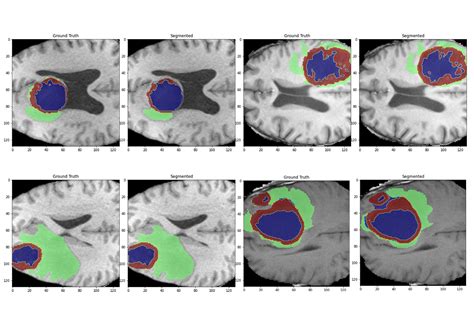 Github Jupiiiiibrain Tumor Segmentation Using 3d U Net