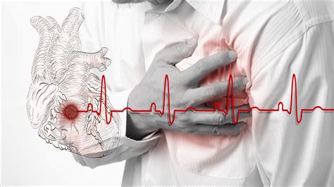 Infarto Agudo Al Miocardio