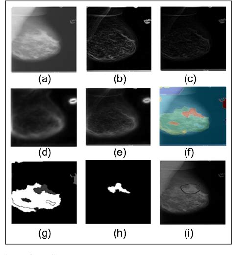 Figure 1 From Automated Multimodal Segmentation Of An Abnormal Breast