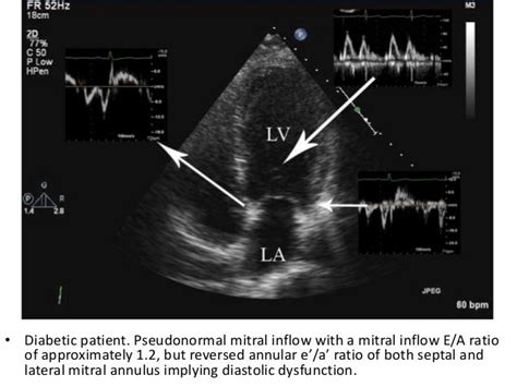 Diastolic Dysfunction Evaluation
