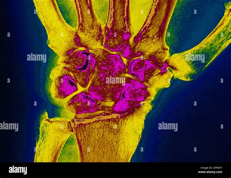 Arthrose Du Poignet Banque De Photographies Et Dimages à Haute