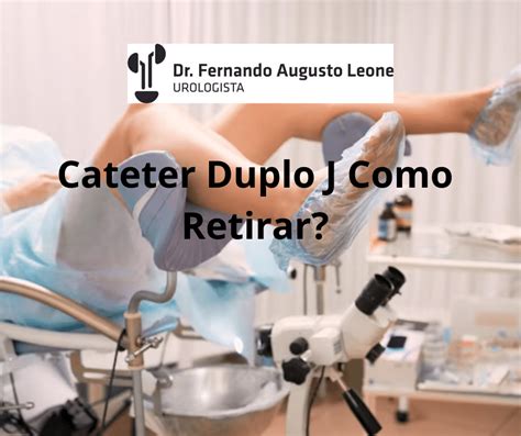 Cateter Duplo J Como Retirar Dr Fernando Leone Urologista BH