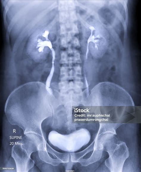 Intravenous Pyelogram Or Ivp Is An Xray Exam Of Urinary Tract After Injection Contrast Media