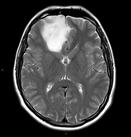 T FLAIR Mismatch Sign Radiology Reference Article Radiopaedia Org