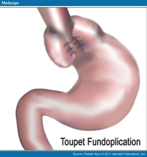 TECHNIQUE OF LAPAROSCOPIC TOUPET FUNDOPLICATION By LASER