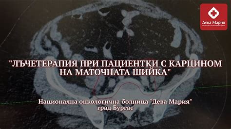 Лъчетерапия при пациентки с карцином на маточната шийка в Национална онкологична болница Дева