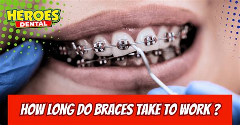 Do K Braces Work At Frank Duke Blog