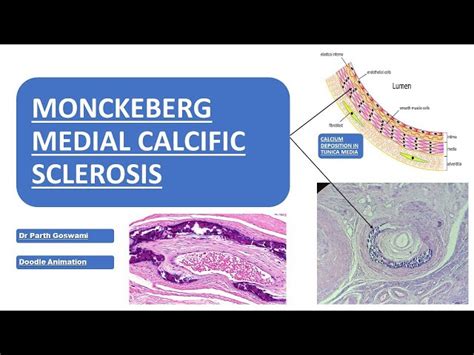 Monckeberg Arteriosclerosis
