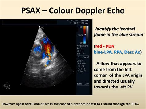 Patent Ductus Arteriosus Echo