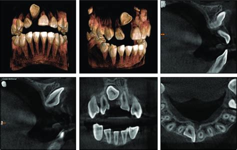Pre Treatment Cone Beam Computed Tomography Cbct Download