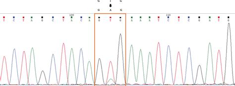 Braf V600e Mutation Analysis Direct Dna Sequencing Data From The Bone